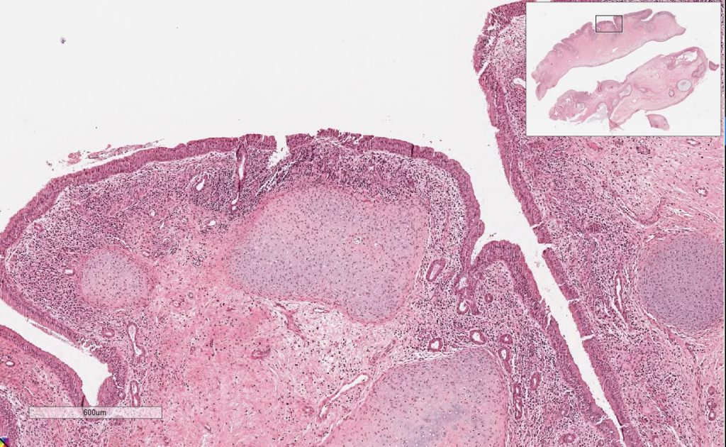 Pathology Image Gallery - DICER1 Syndrome